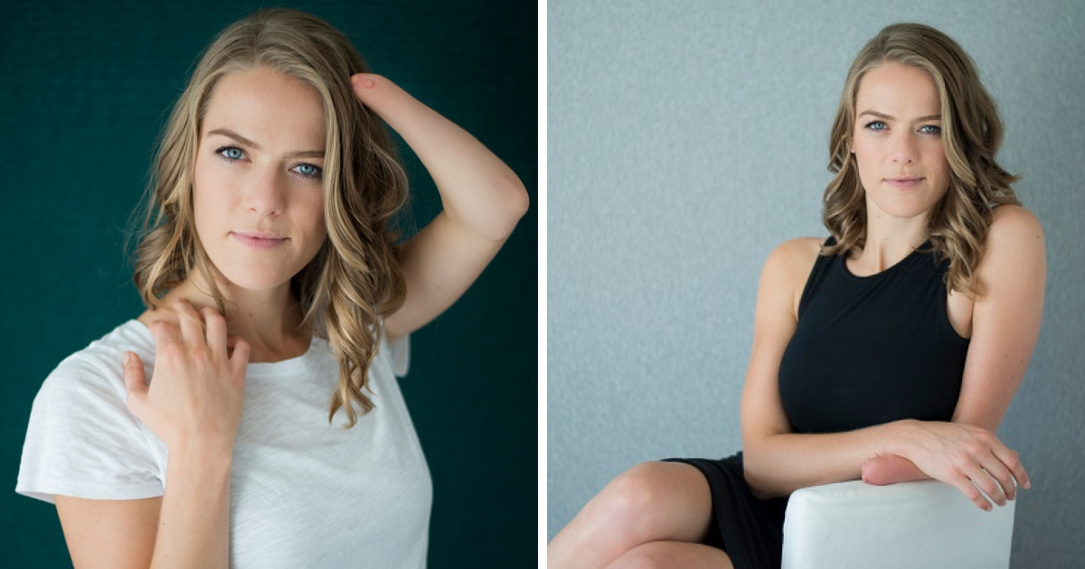 I Love Modeling With My Disability | Bored Panda