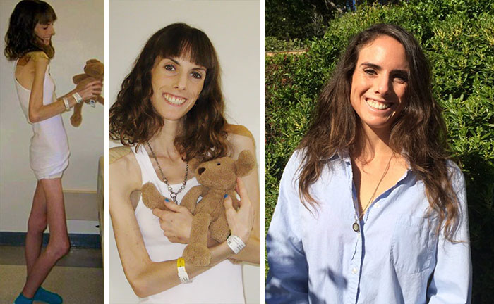 Anorexia Celebrities With Anorexia Nervosa