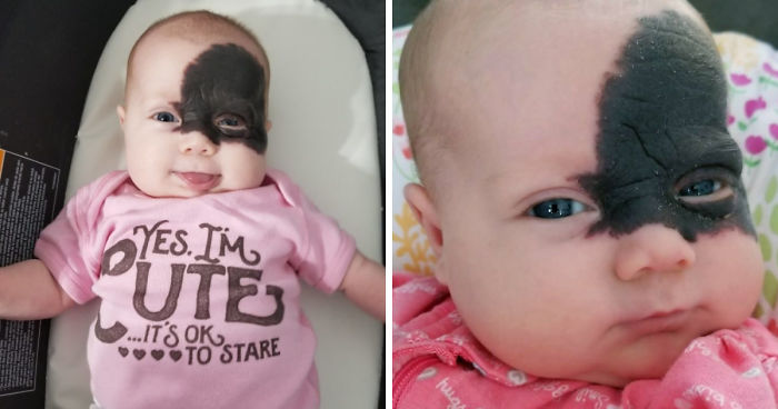 This Baby Was Born With A Birthmark Which Turned Her Into “Little ...