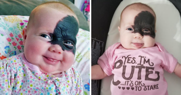 This Baby Was Born With A Birthmark Which Turned Her Into “Little ...