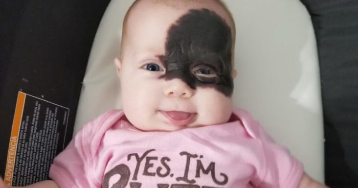 This Baby Was Born With A Birthmark Which Turned Her Into “Little ...
