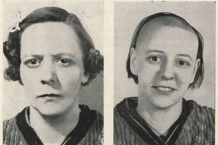 21 Disturbing Pictures Of Lobotomy Before And After Bored Panda