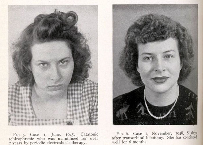 21 Disturbing Pictures Of Lobotomy Before And After Bored Panda