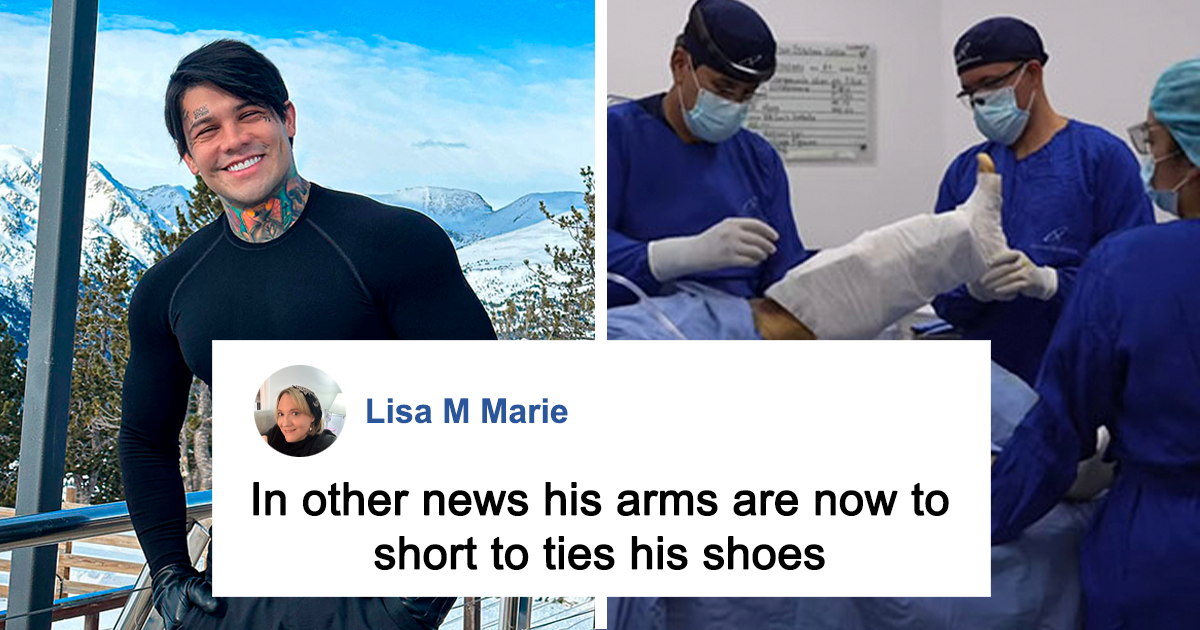 Influencer Spends $175,000 On “Most Painful” Leg-Lengthening Surgery To ...