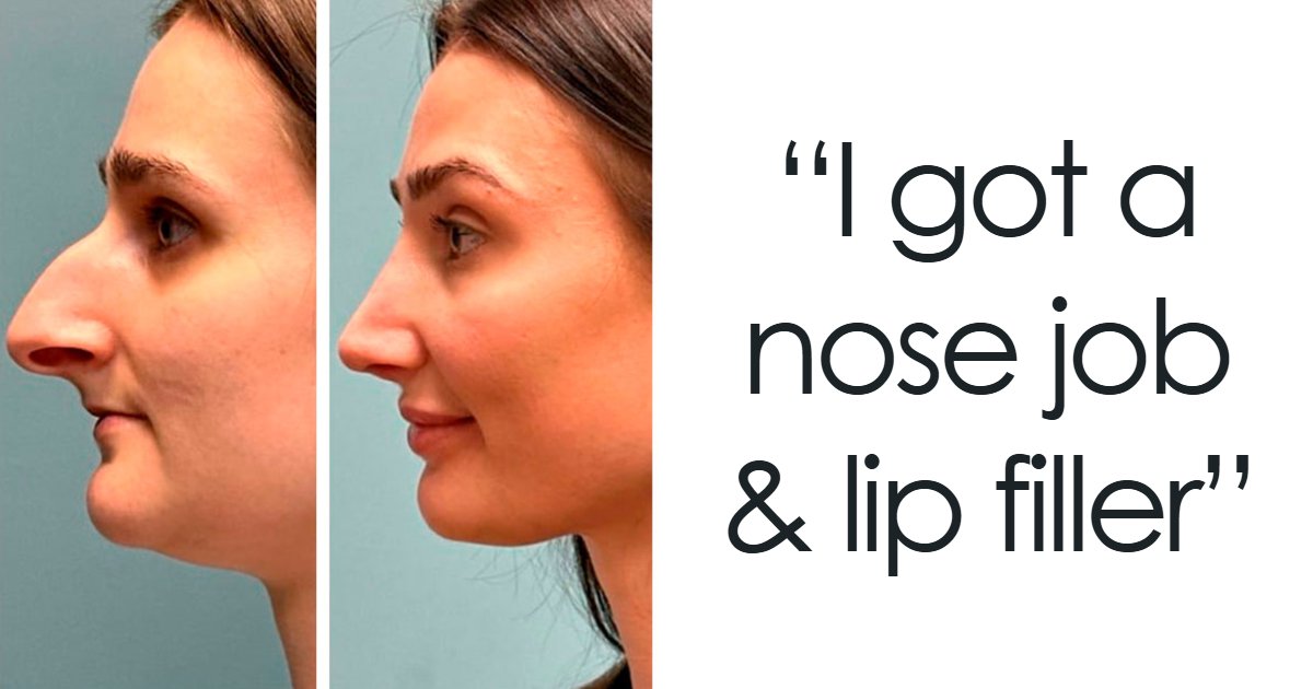 “So Happy With The Results!”: 41 Stunning Transformations That Reveal ...