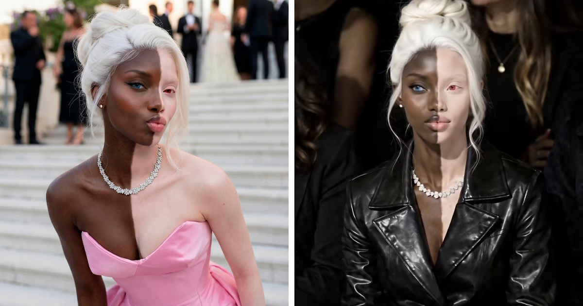Model Goes Viral For Her Strikingly Unusual Skin Coloration, But There ...